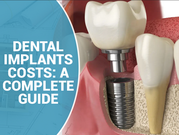 Dental Implants Cost: A Complete Guide