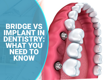 Bridge vs Implant in Dentistry-What You Need to Know